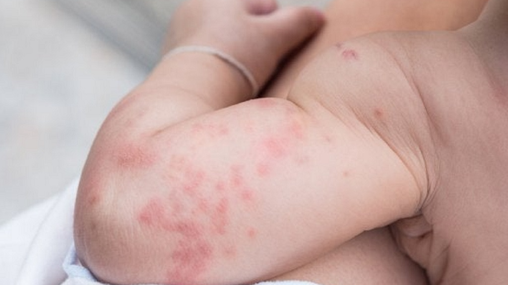 Boutons de chaleur chez les bébés : comment s’en débarrasser ? Le point ...