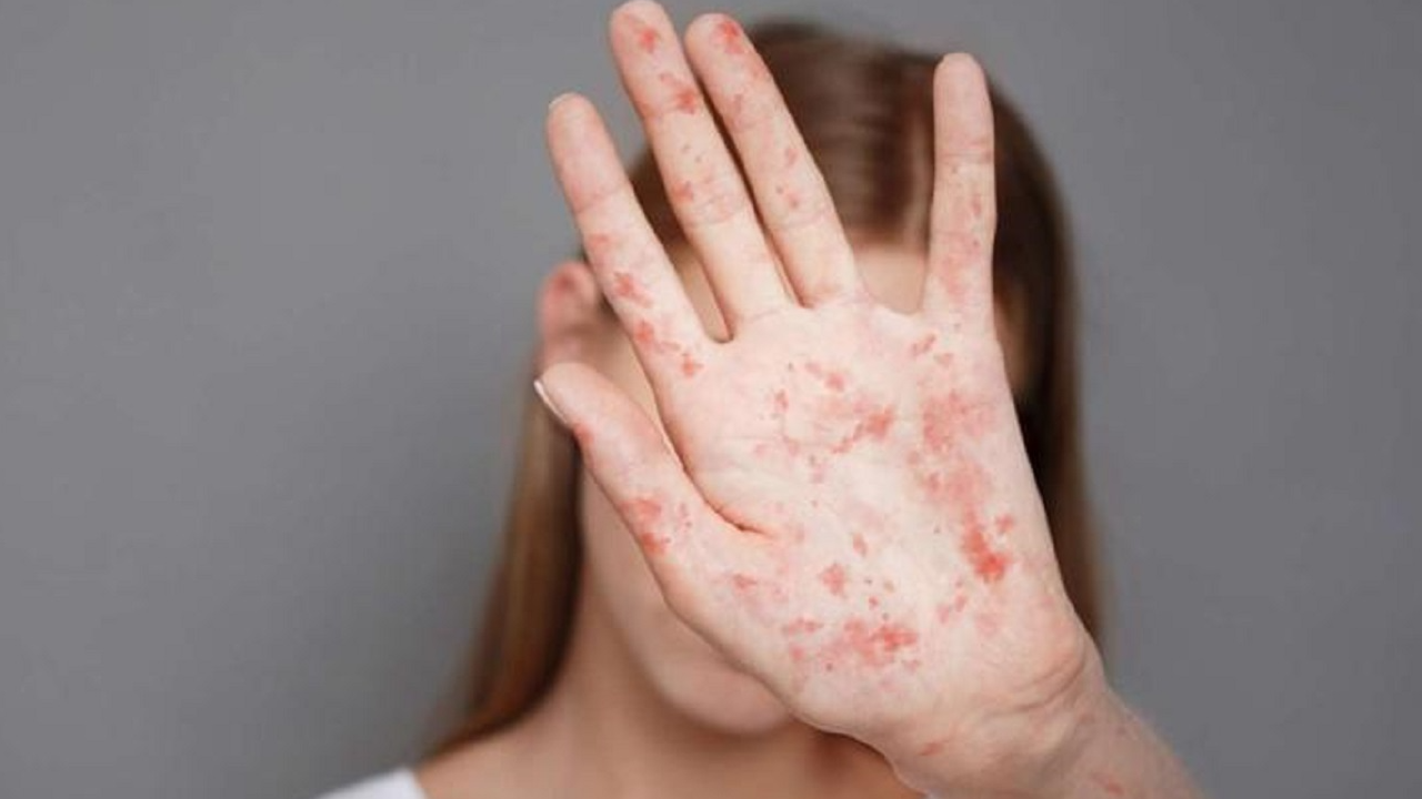 Rougeole: l'OMS alerte sur la forte hausse de la maladie dans le monde