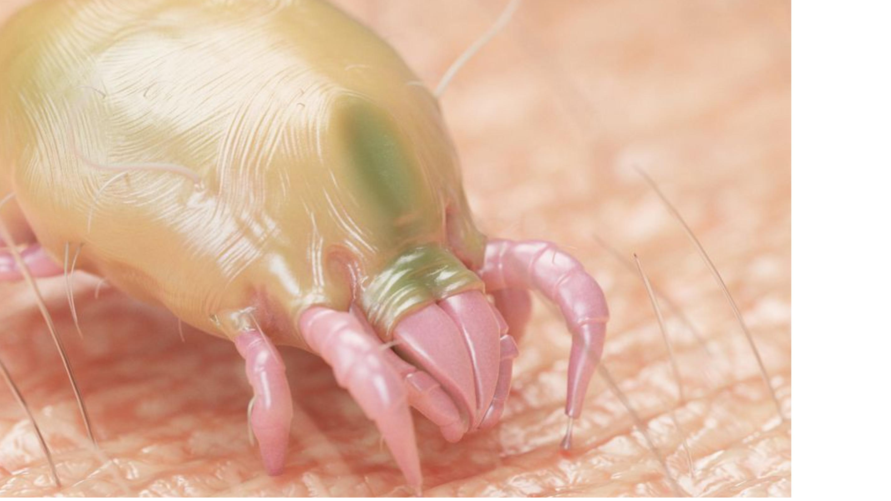 Comment soigner une allergie aux acariens ? (Spécialiste)