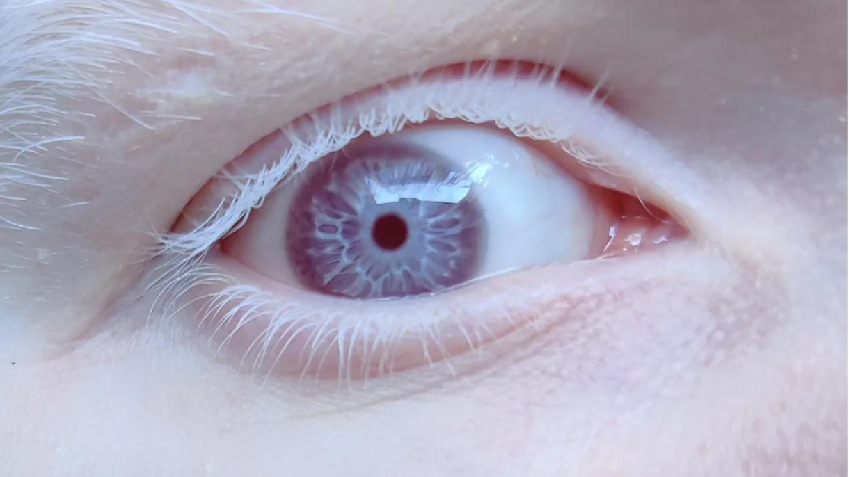 Tout ce qu'il faut savoir sur l'albinisme oculaire