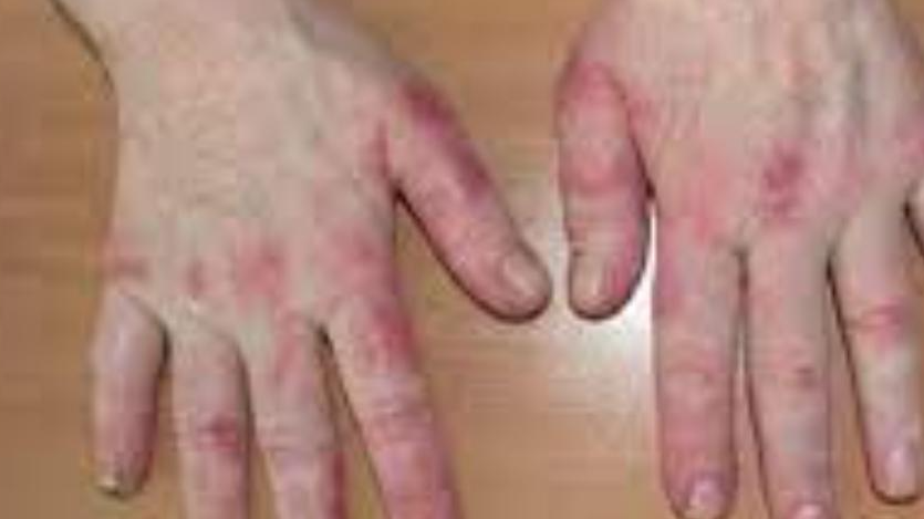 Tout ce qu'il faut savoir sur la dermatomyosite, cette maladie ...