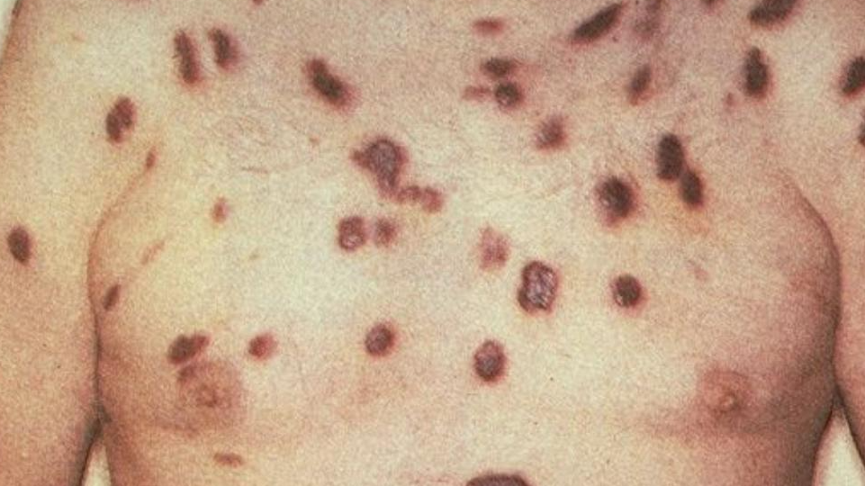 Sarcome : Tout ce qu’il faut savoir sur ce type de tumeurs cancéreuses