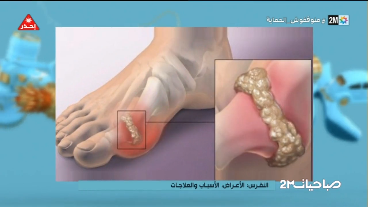 Santé: Comprendre la goutte, cette maladie rhumatismale très répandue
